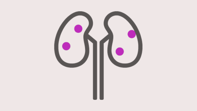 Cancer - Bristol Myers Squibb