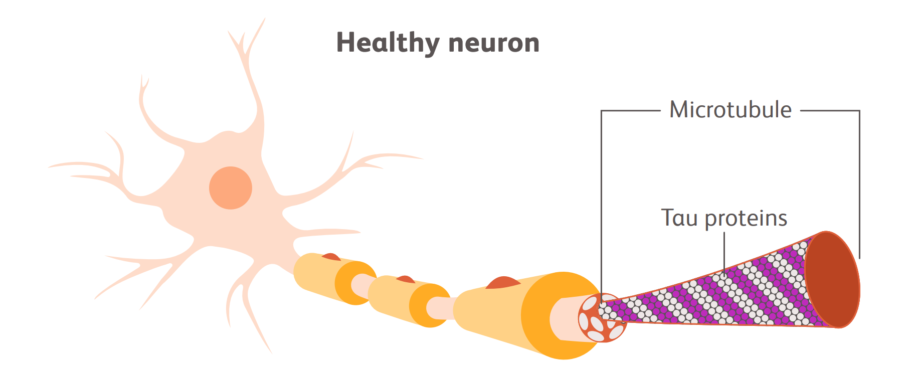 Tau in Alzheimer’s disease fact sheet – Bristol Myers Squibb