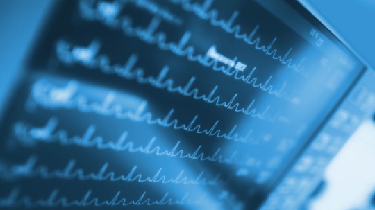 Wearable technology advancements to support AFib detection – Bristol ...